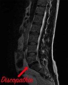 Pathology of the lumbar spine - Rennais Institute of Vertebral Surgery ...