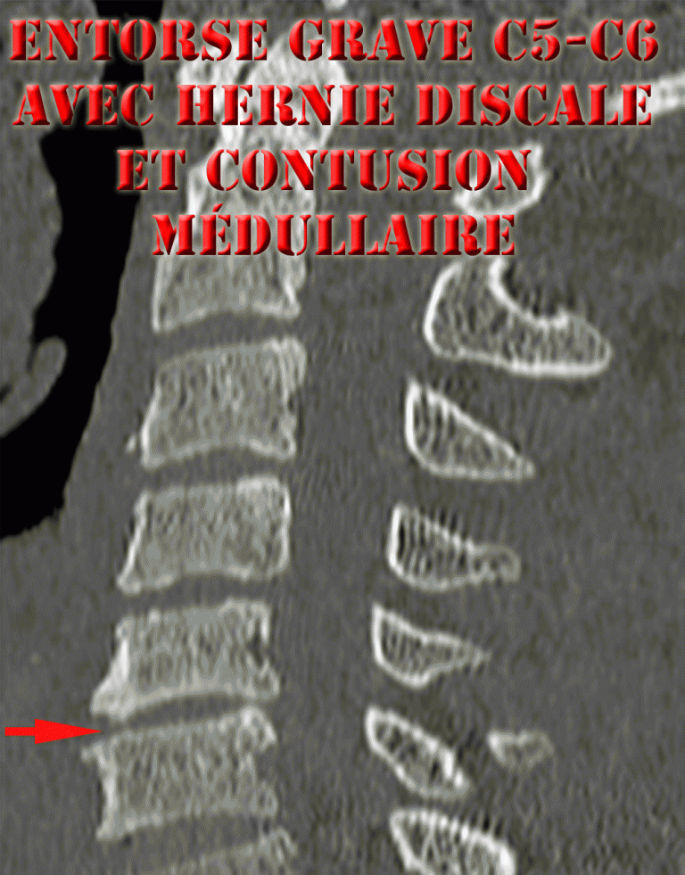 Fractures - Institut Rennais de Chirurgie Vertébrale - IRCV