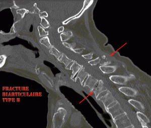 Fractures - Institut Rennais de Chirurgie Vertébrale - IRCV